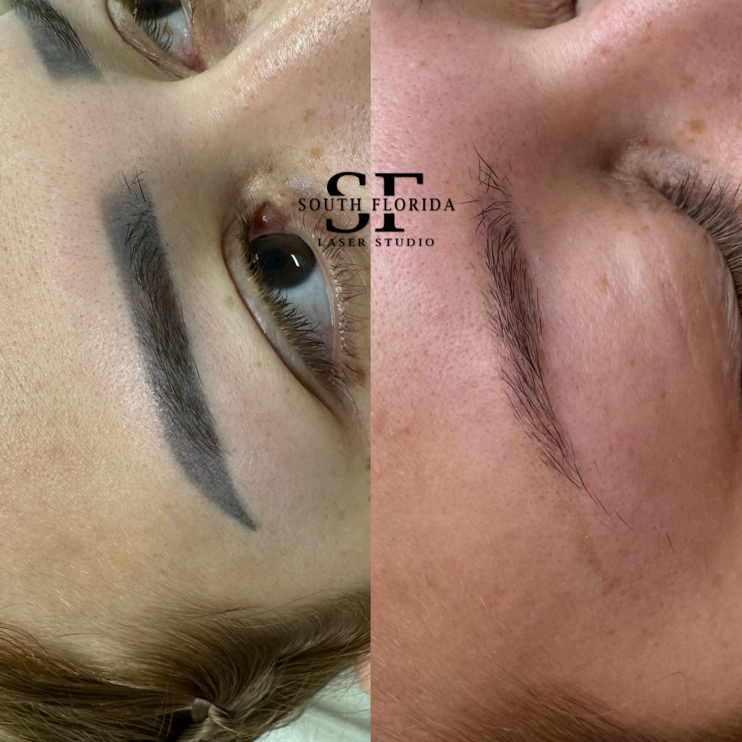 Before and After Laser Eyebrow Removal - South Florida Laser Studio